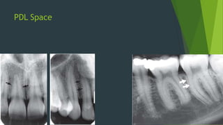 Normal Radiographic Anatomy of Oral Structures | PPTX