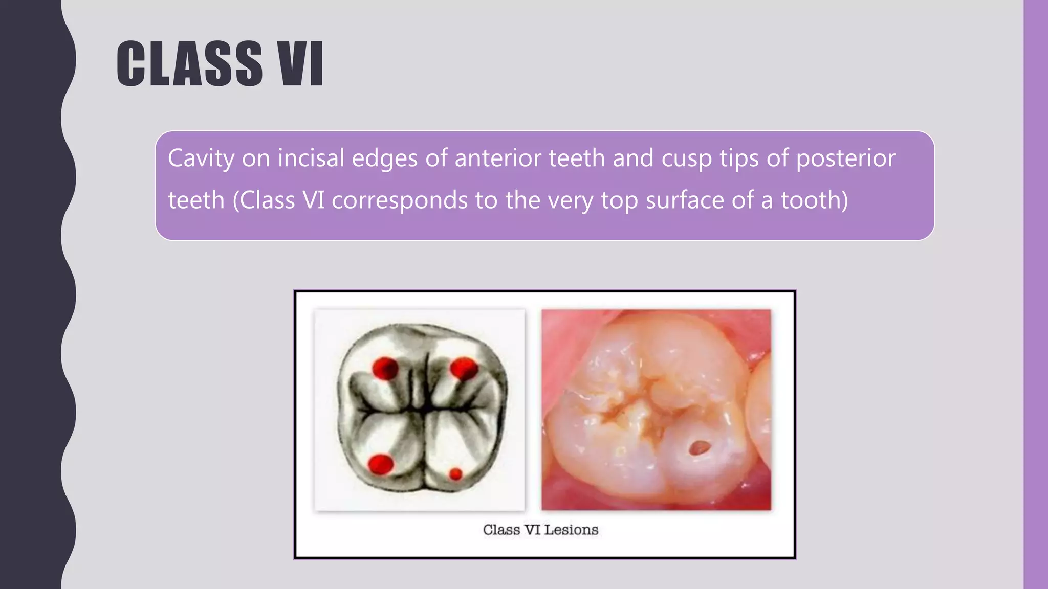 dental caries #2 | PPT