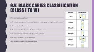 dental caries #2 | PPT