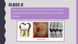 dental caries #2 | PPT