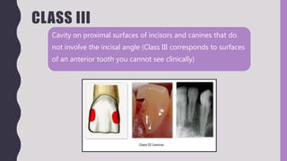 dental caries #2 | PPT