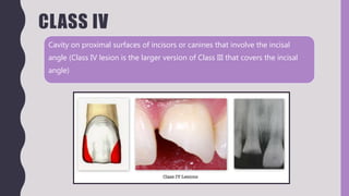 dental caries #2 | PPT