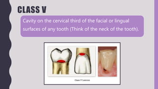 dental caries #2 | PPT