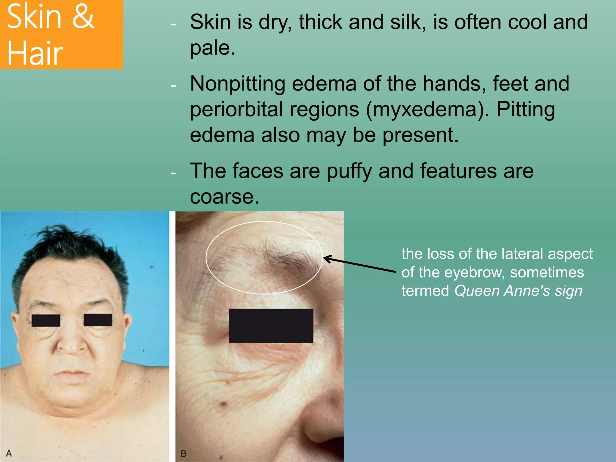 Hypothyroidism: Evaluation & Management by Dr Selim | PPT