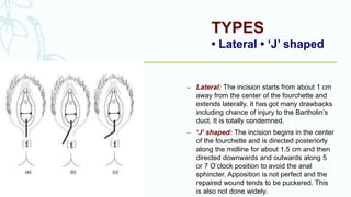 2. partograph & Episiotomy | PPT