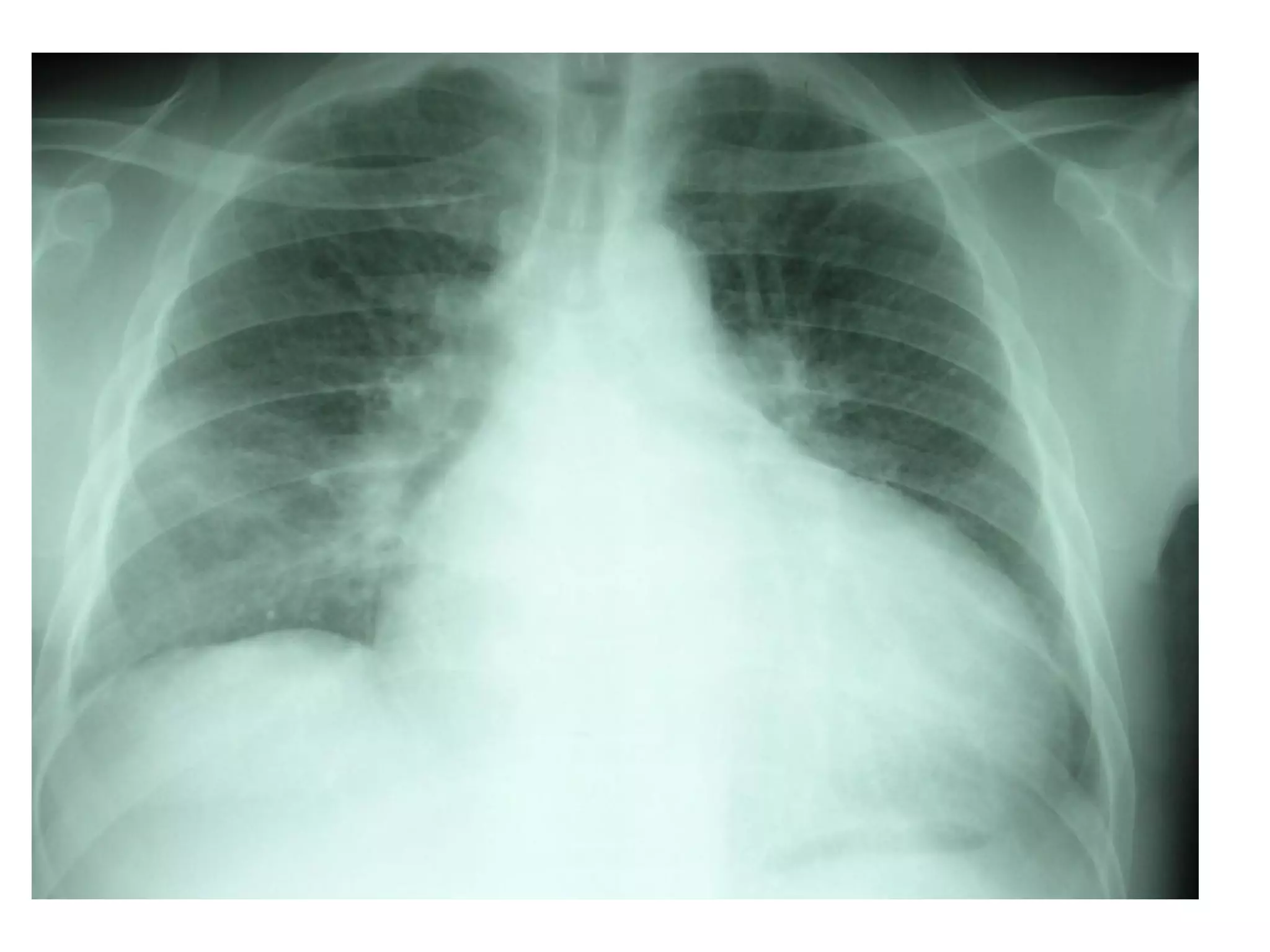 HỘI CHỨNG SUY TIM | PDF