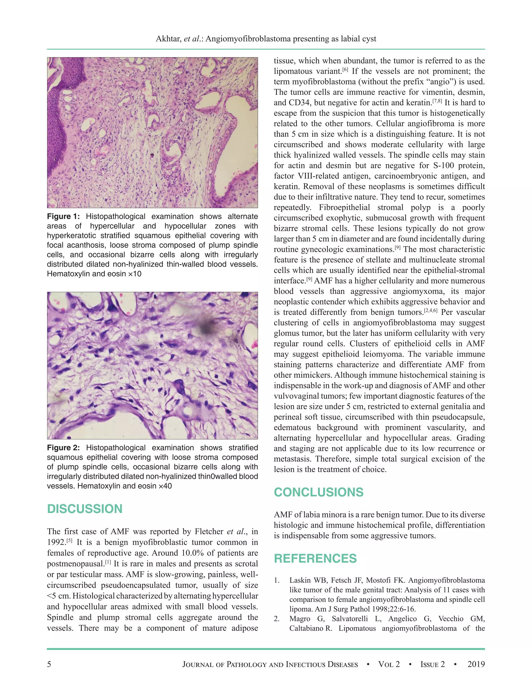 Angiomyofibroblastoma Presenting as Labia Minora Cyst | PDF
