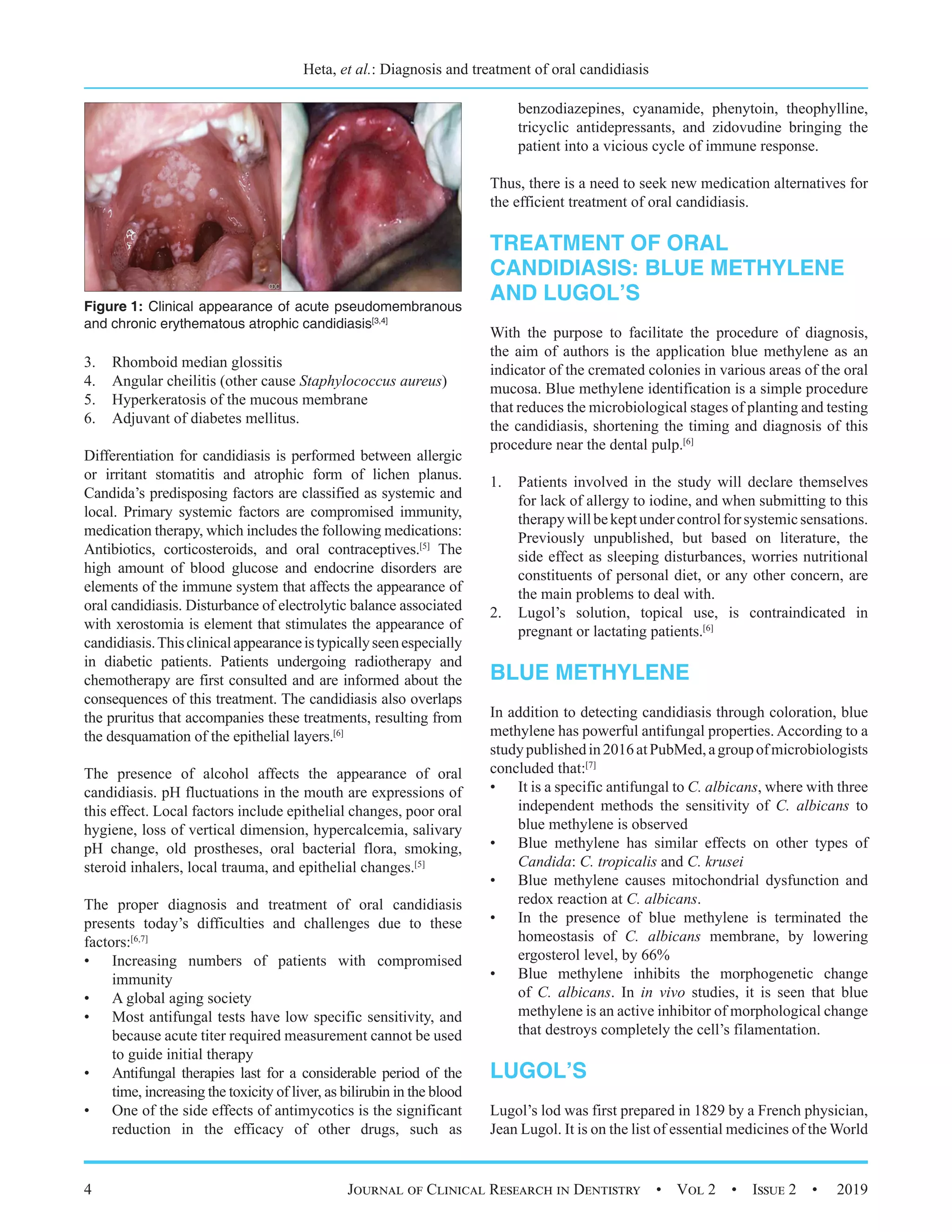 A Modality in the Diagnosis and Treatment of Oral Candidiasis | PDF