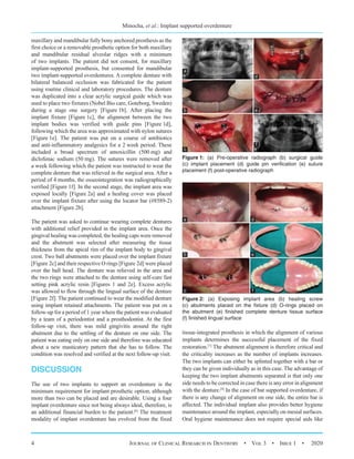 An 2/2 Implant Overdenture | PDF