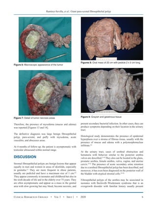 Giant Para-scrotal Fibroepithelial Polyp | PDF | Blood Disorders ...