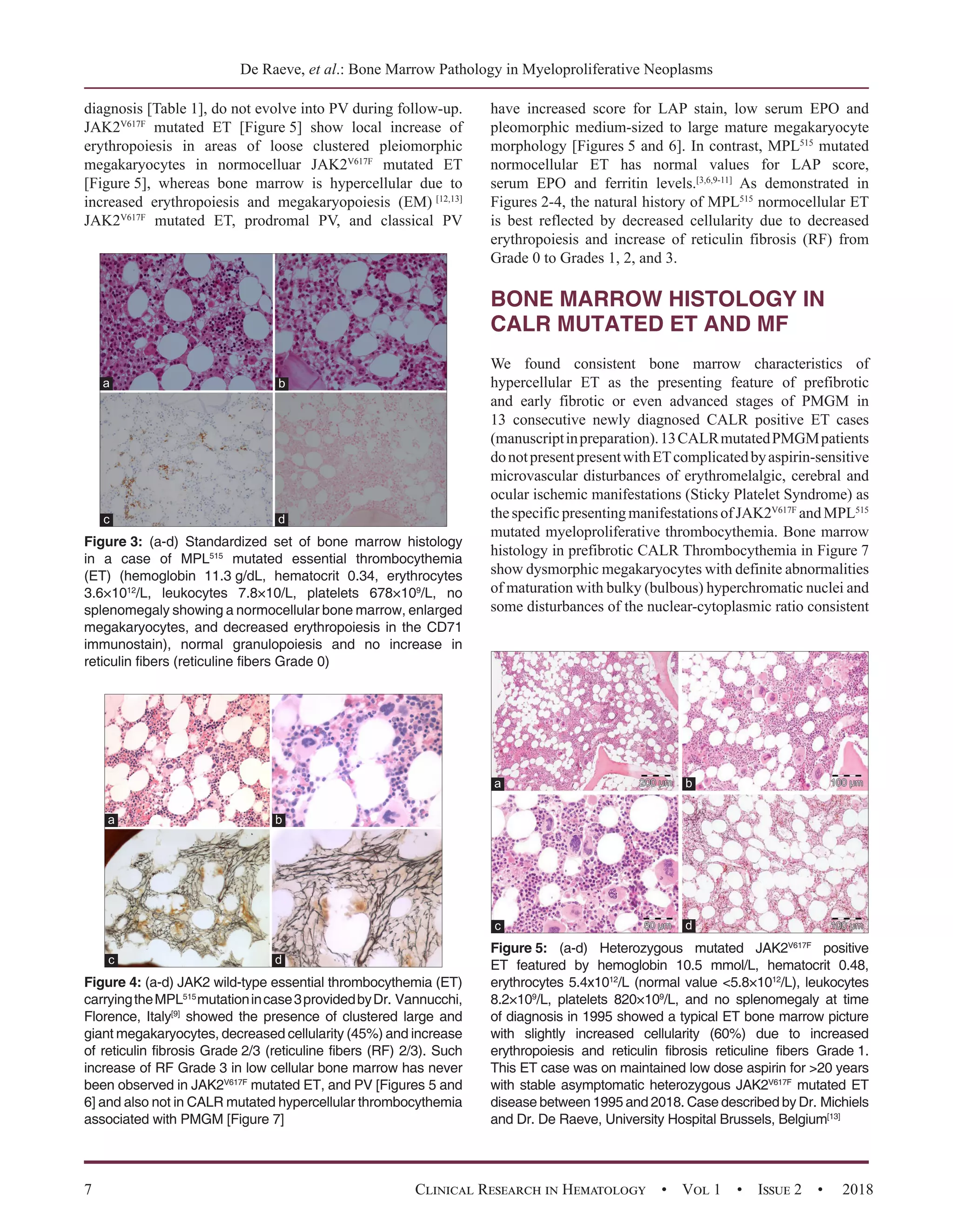 Bone Marrow Histology is a Pathognomonic Clue to Each of the JAK2V617F ...