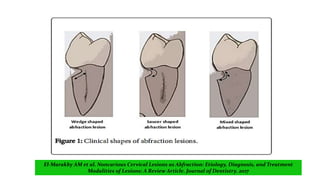 NON CARIOUS LESIONS | PPTX