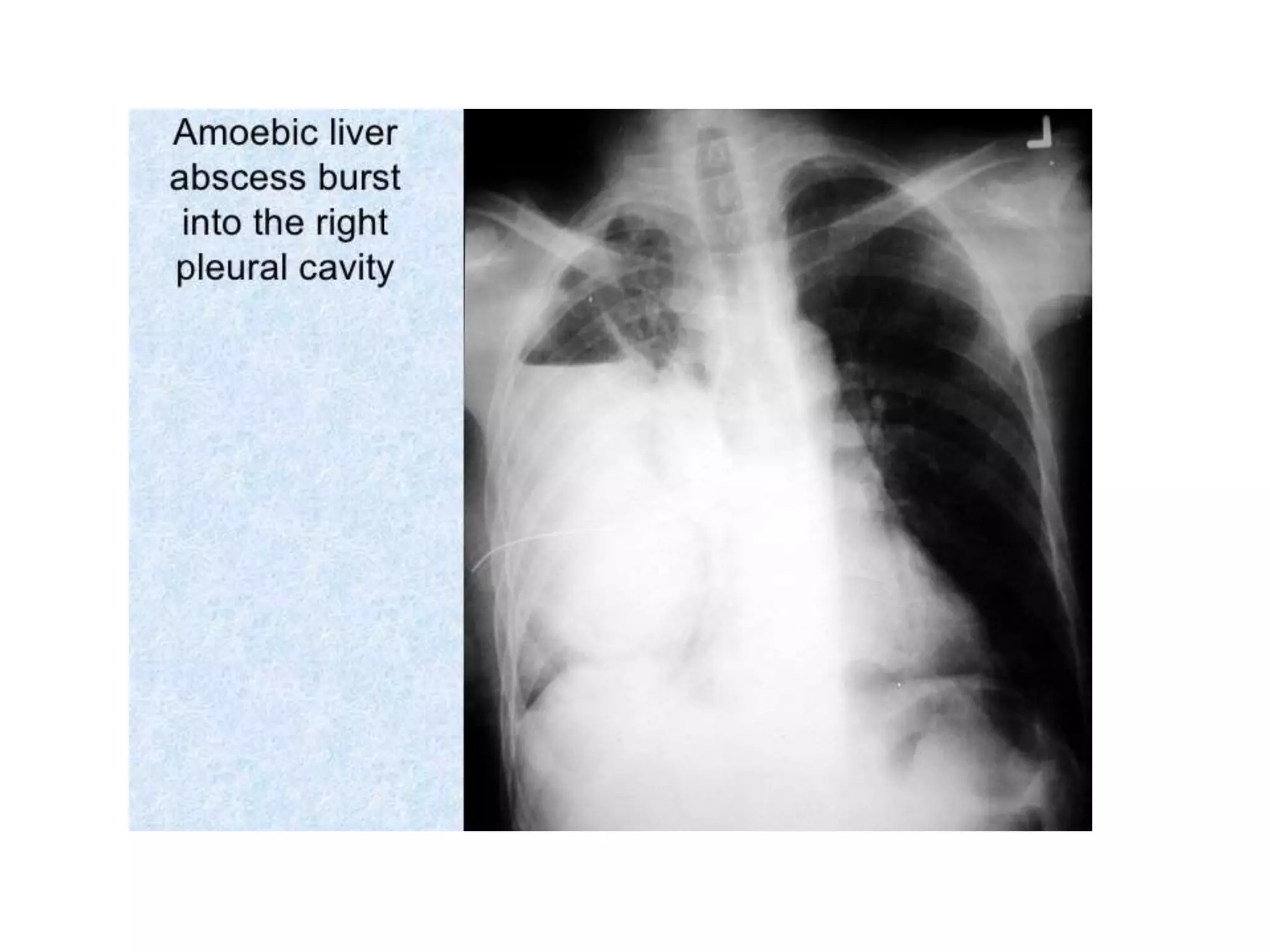 2.4.4.4b Abses Hati.pptx