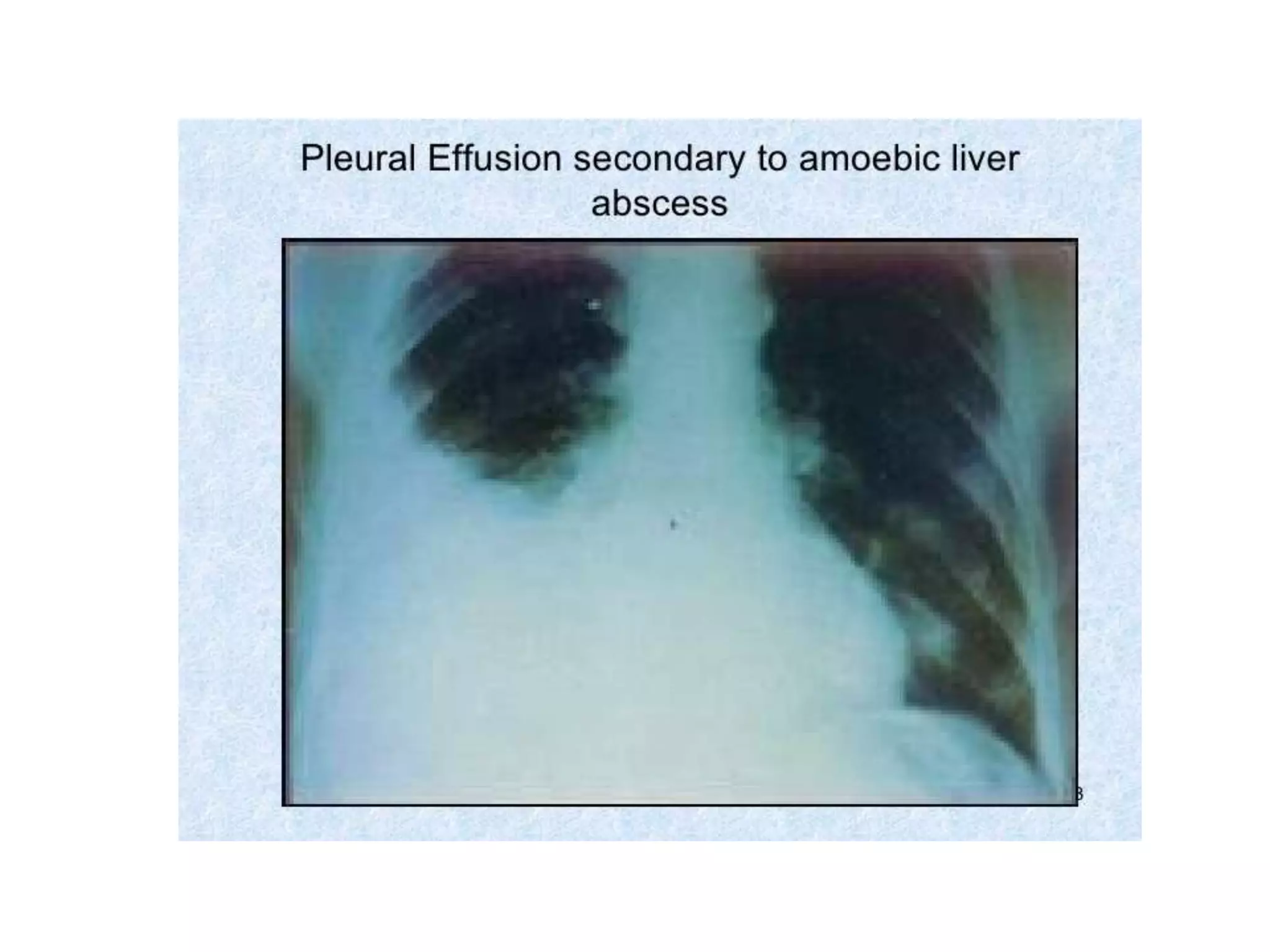 2.4.4.4b Abses Hati.pptx