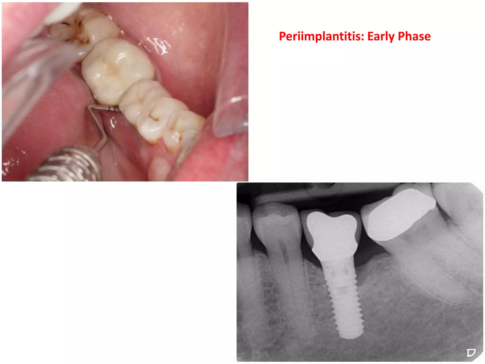 2. Periimplantitis 2017.pptx