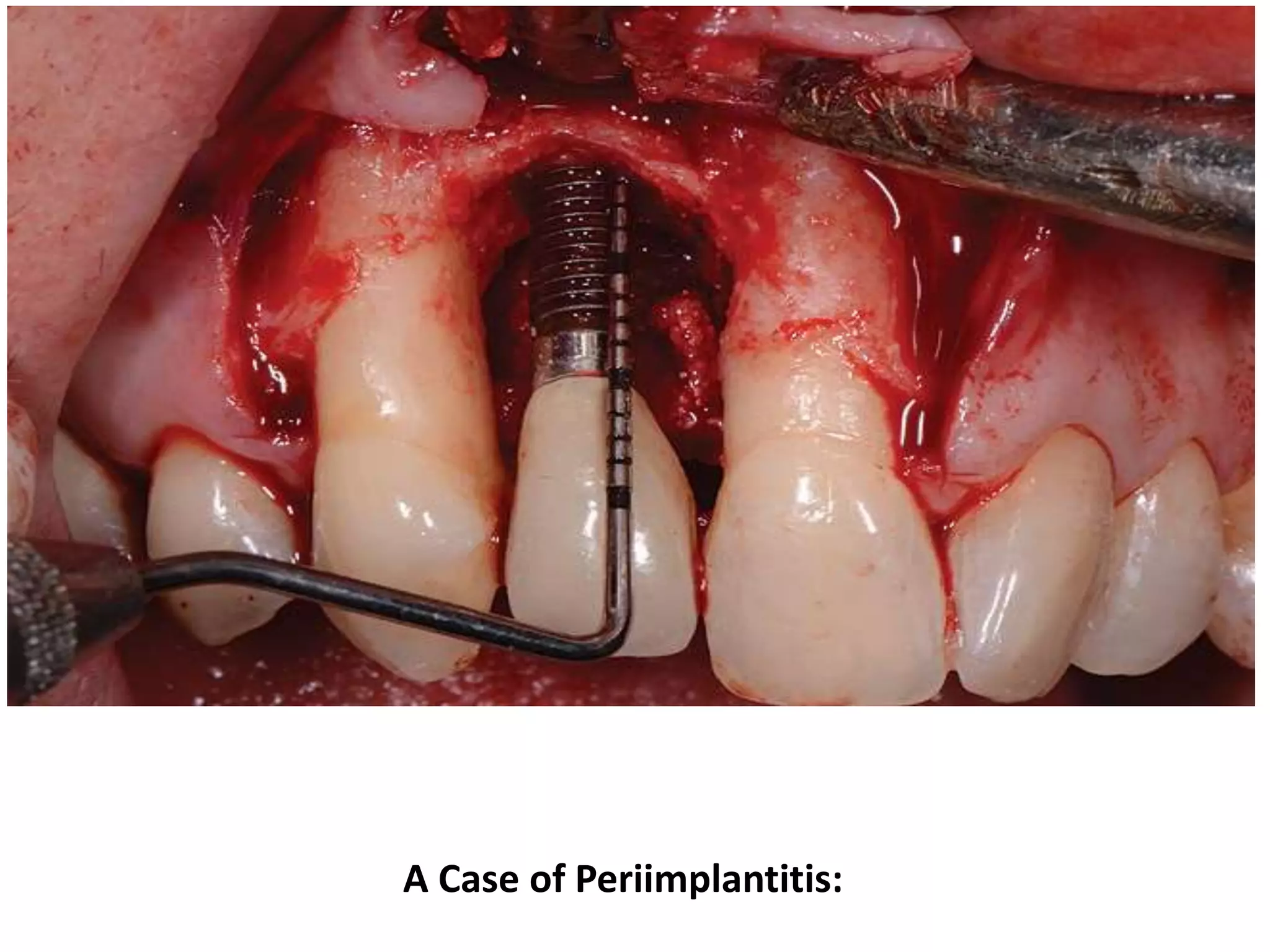 2. Periimplantitis 2017.pptx