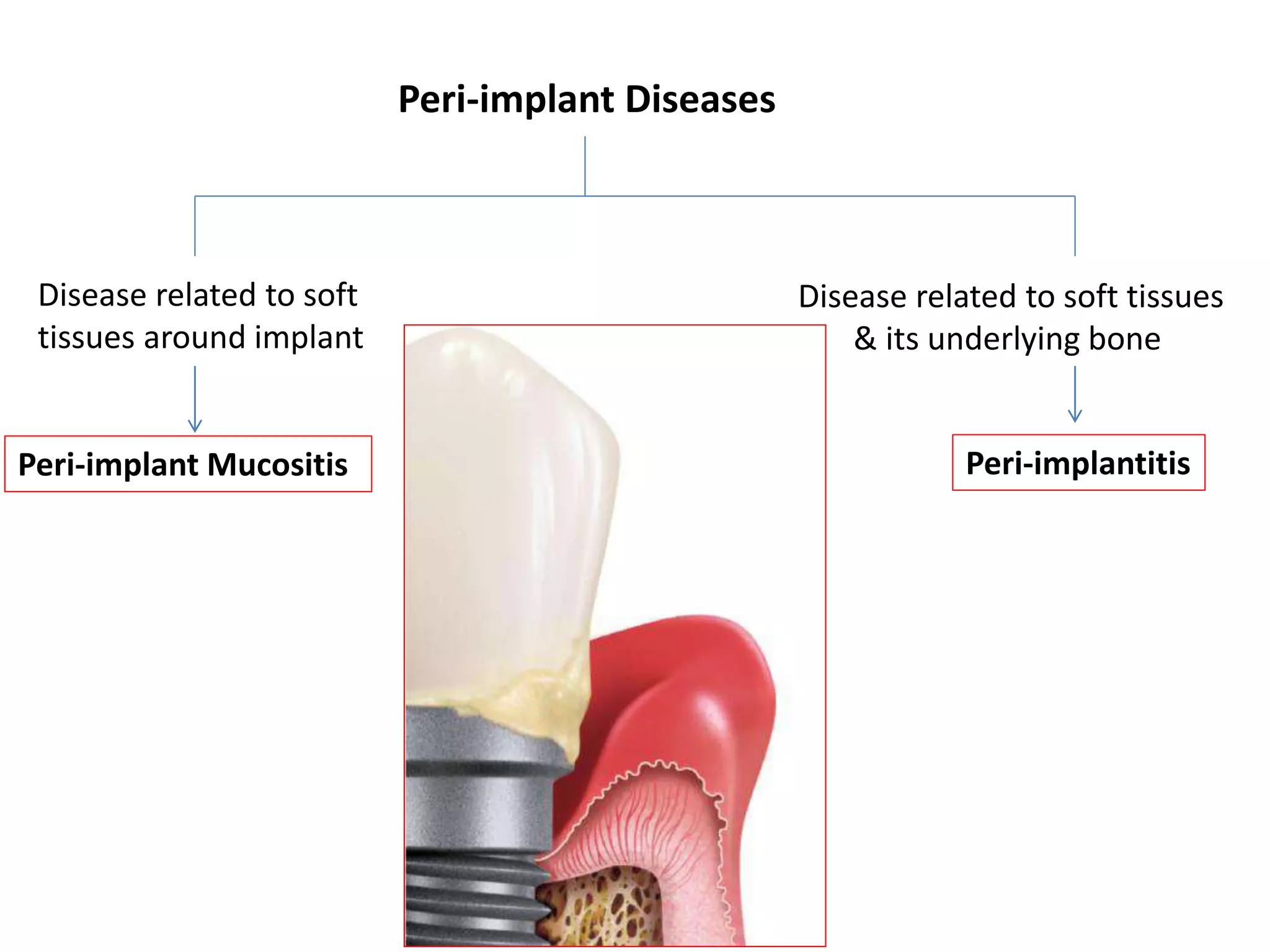 2. Periimplantitis 2017.pptx