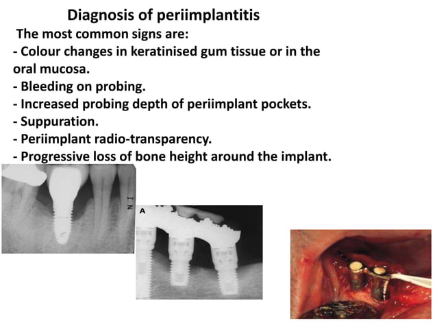 2. Periimplantitis 2017.pptx