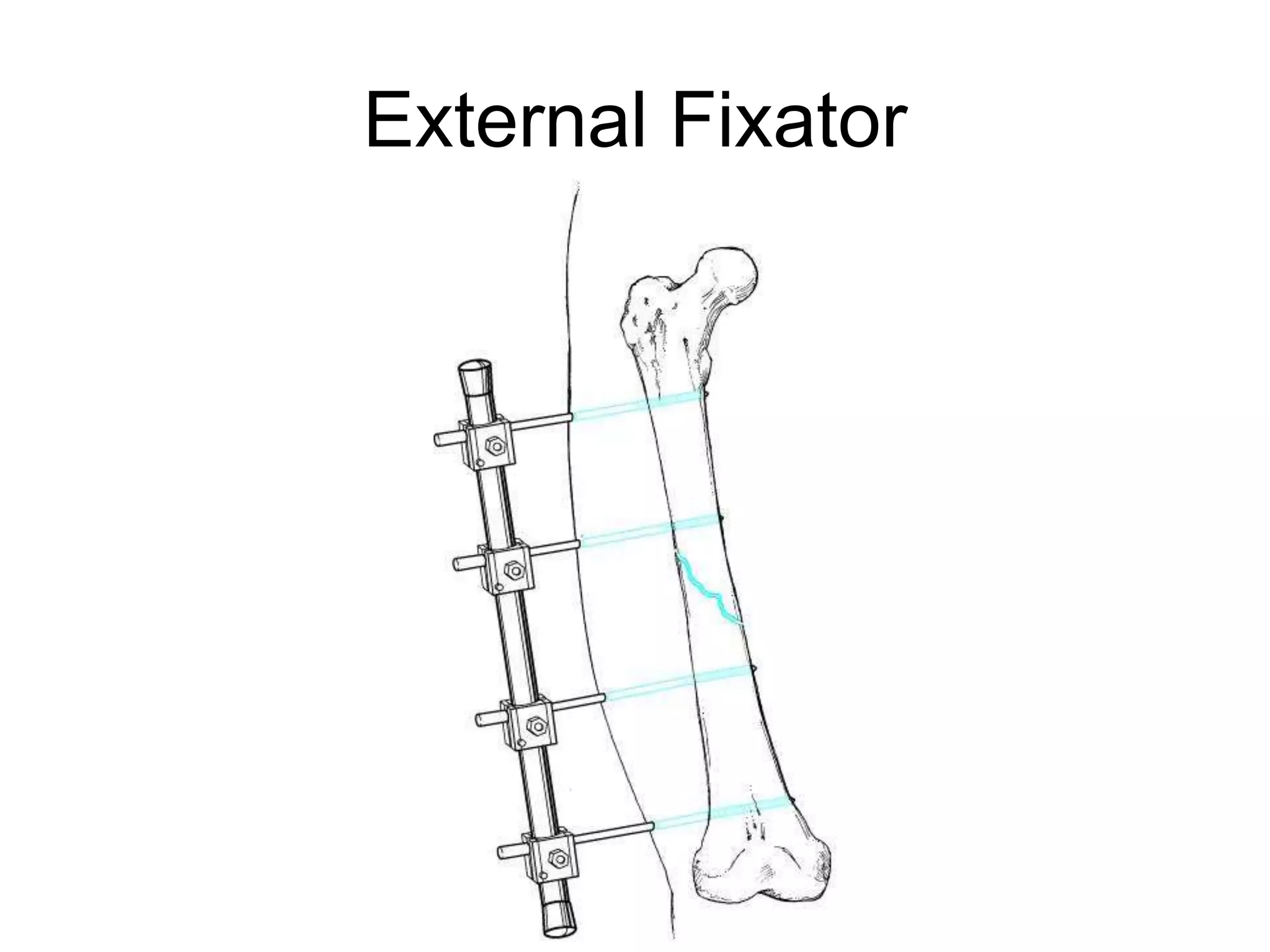 GENERAL PRINCIPLES OF CLOSED AND OPEN FRACTURES | PPT