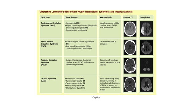 2. Stroke Localisation.pdf
