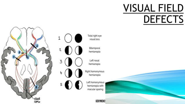 2. Visual field examination and abnormalities.pptx