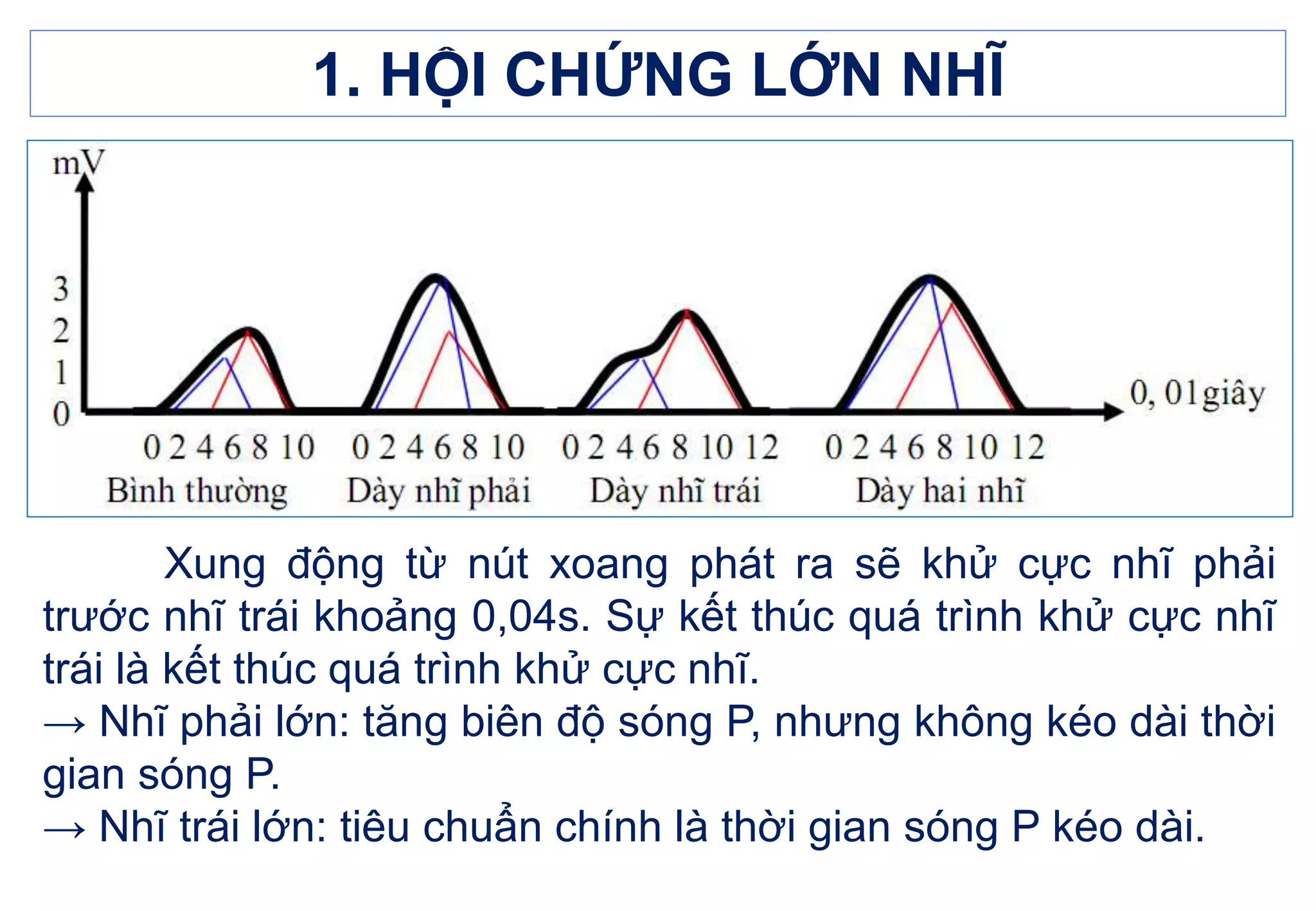 2. HỘI CHỨNG LỚN CÁC BUỒNG TIM TRÊN ECG.ppt