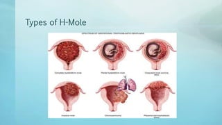 2.-Gestational-Throphoblastic-Disease.pptx