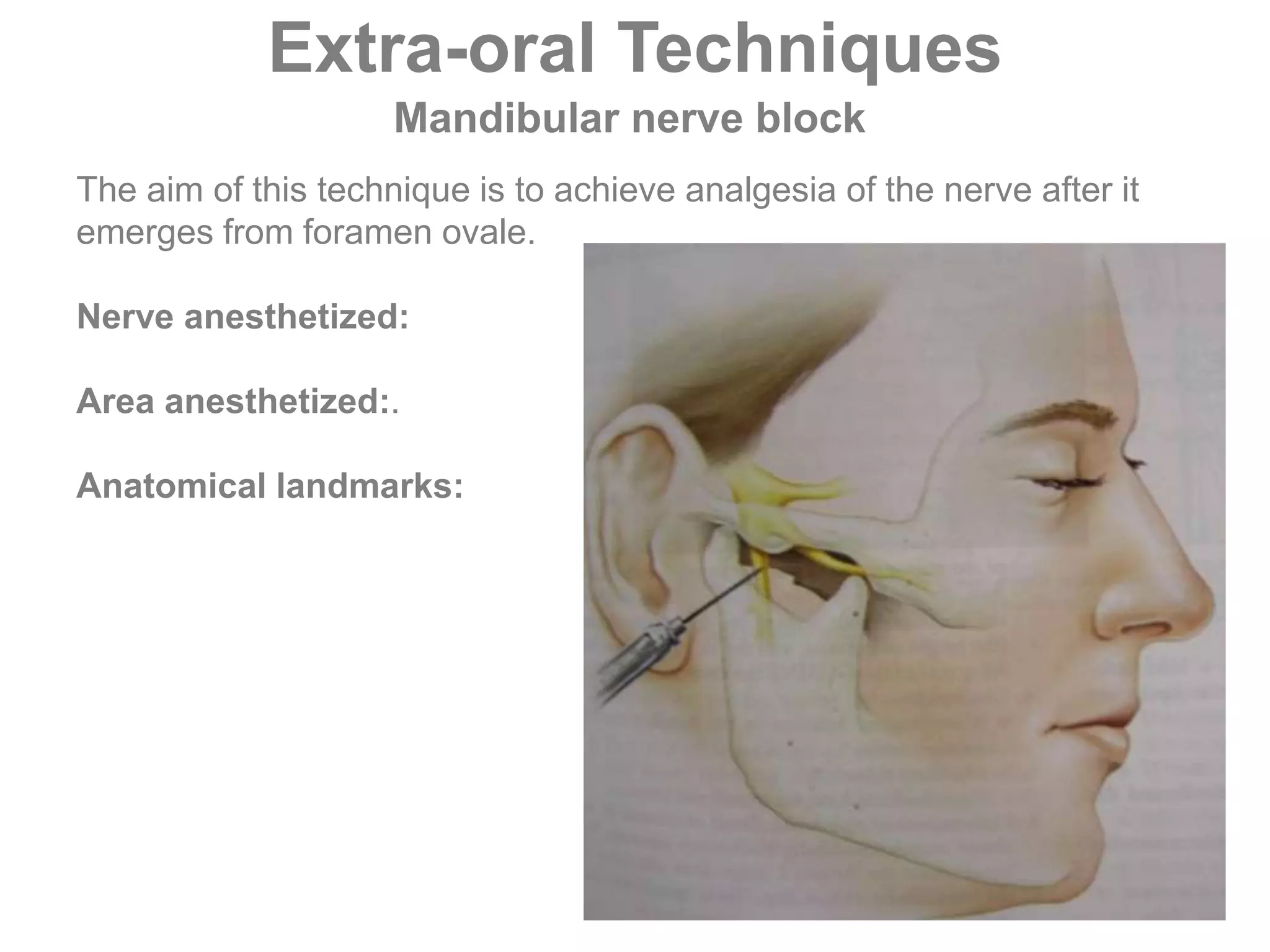 2.Tech of Mandibular Anesthesia.ppt