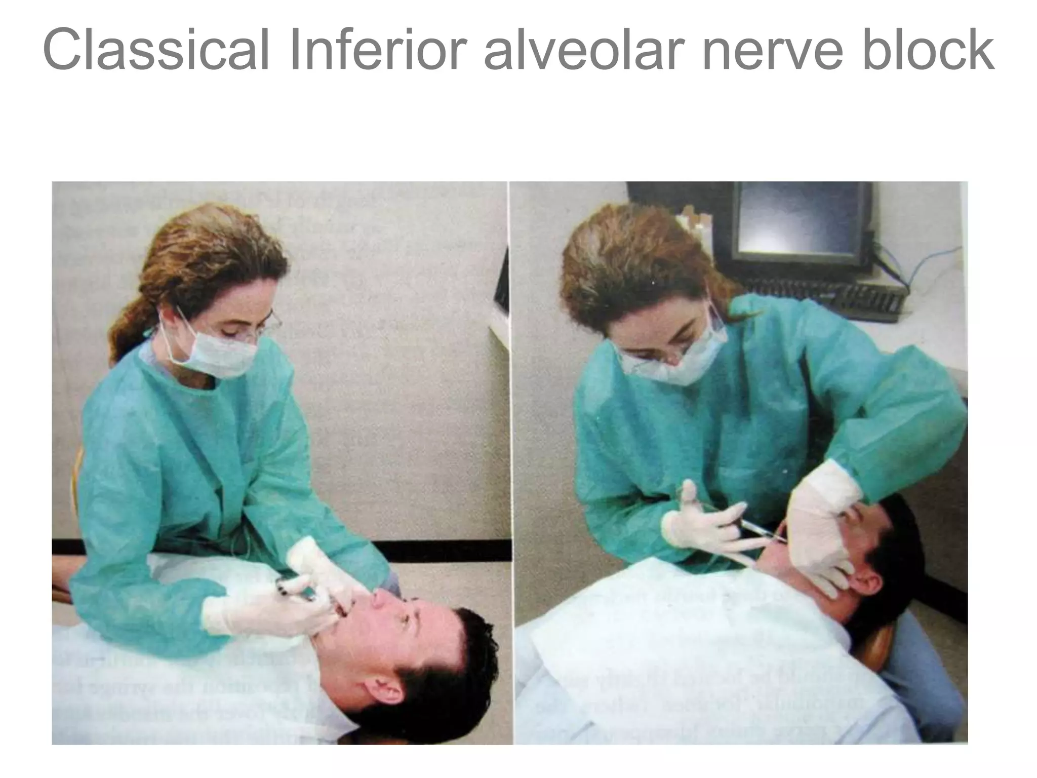2.Tech of Mandibular Anesthesia.ppt