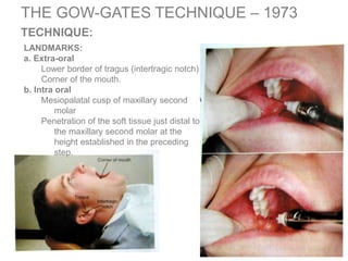 2.Tech of Mandibular Anesthesia.ppt