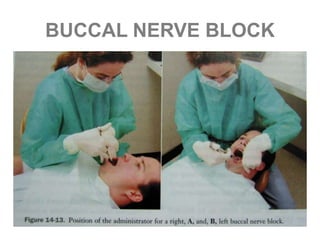 2.Tech of Mandibular Anesthesia.ppt