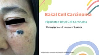 2. dr Airin - Identification of Skin Cancer Where are We.pdf