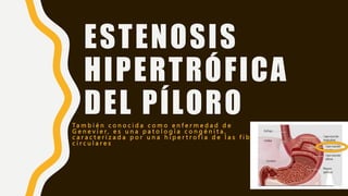2.- hipertrofia de piloro.pptx