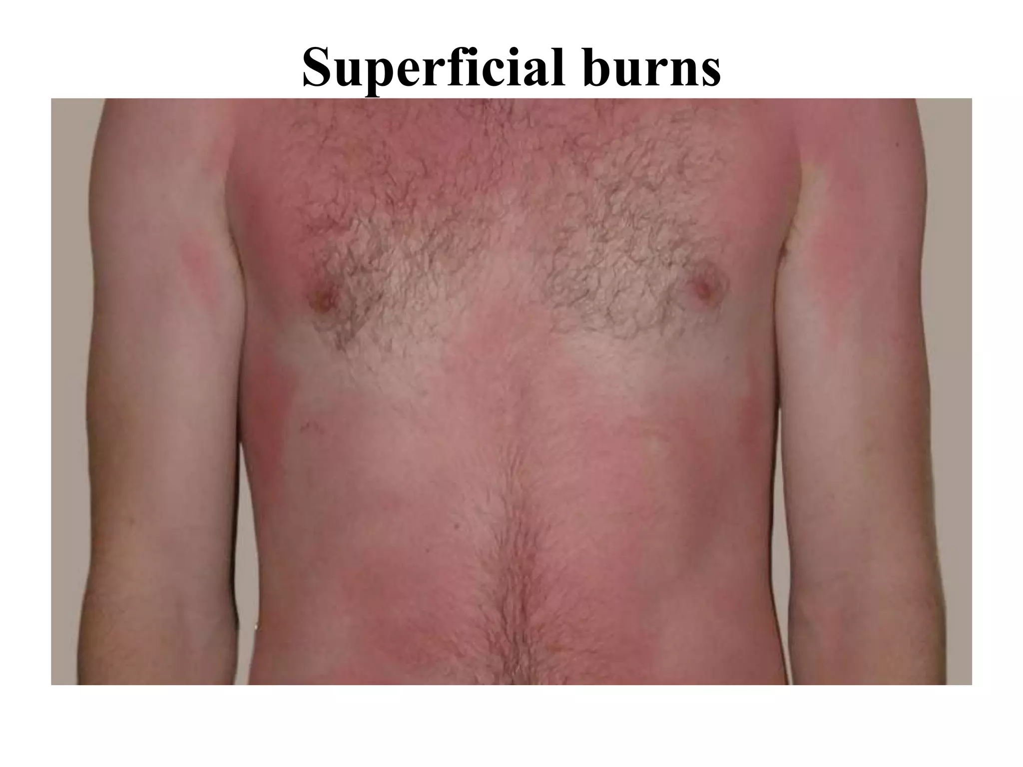 2. Burns and cold injuries.ppt