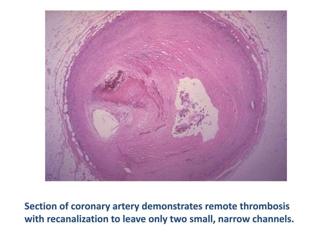 2.-Thrombosis.pptx