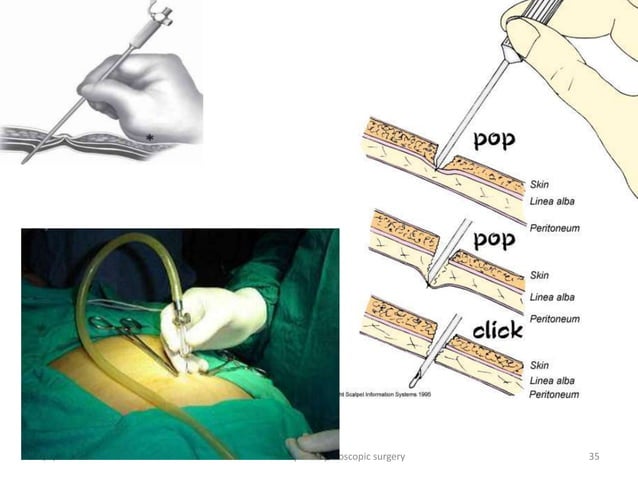 2. SET UP FOR LAPAROSCOPIC SURGERY phase 3 (1).ppt