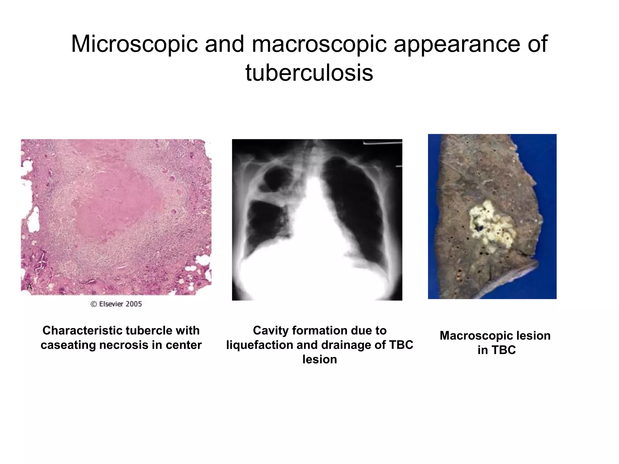 2.Chronic and Granulomatous Inflammation by Dr Mgaya.ppt