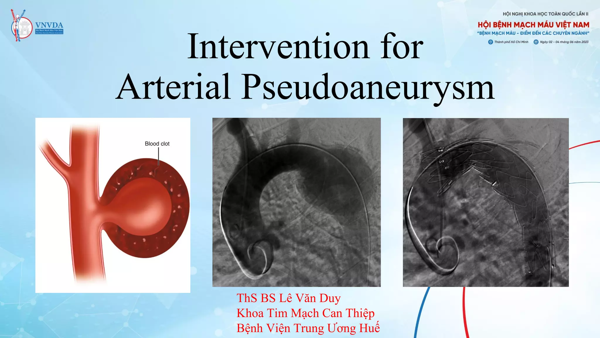 Intervention for Arterial Pseudoaneurysm | PDF