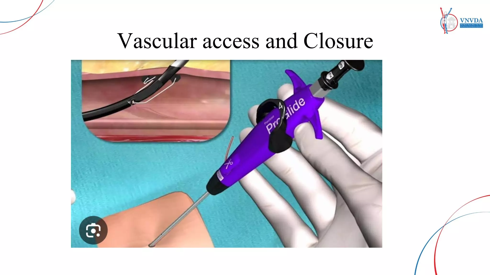 Intervention for Arterial Pseudoaneurysm | PDF