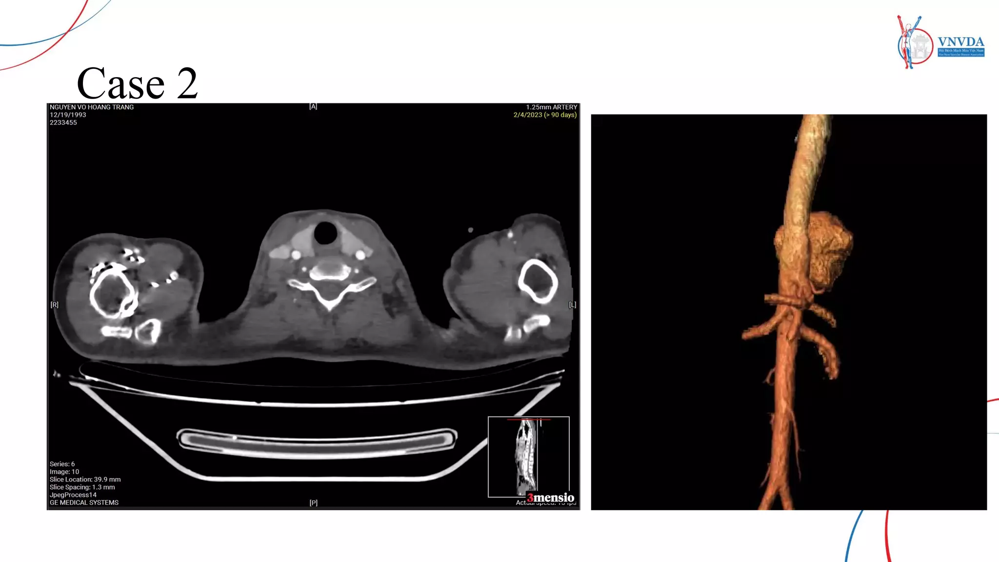 Intervention for Arterial Pseudoaneurysm | PDF