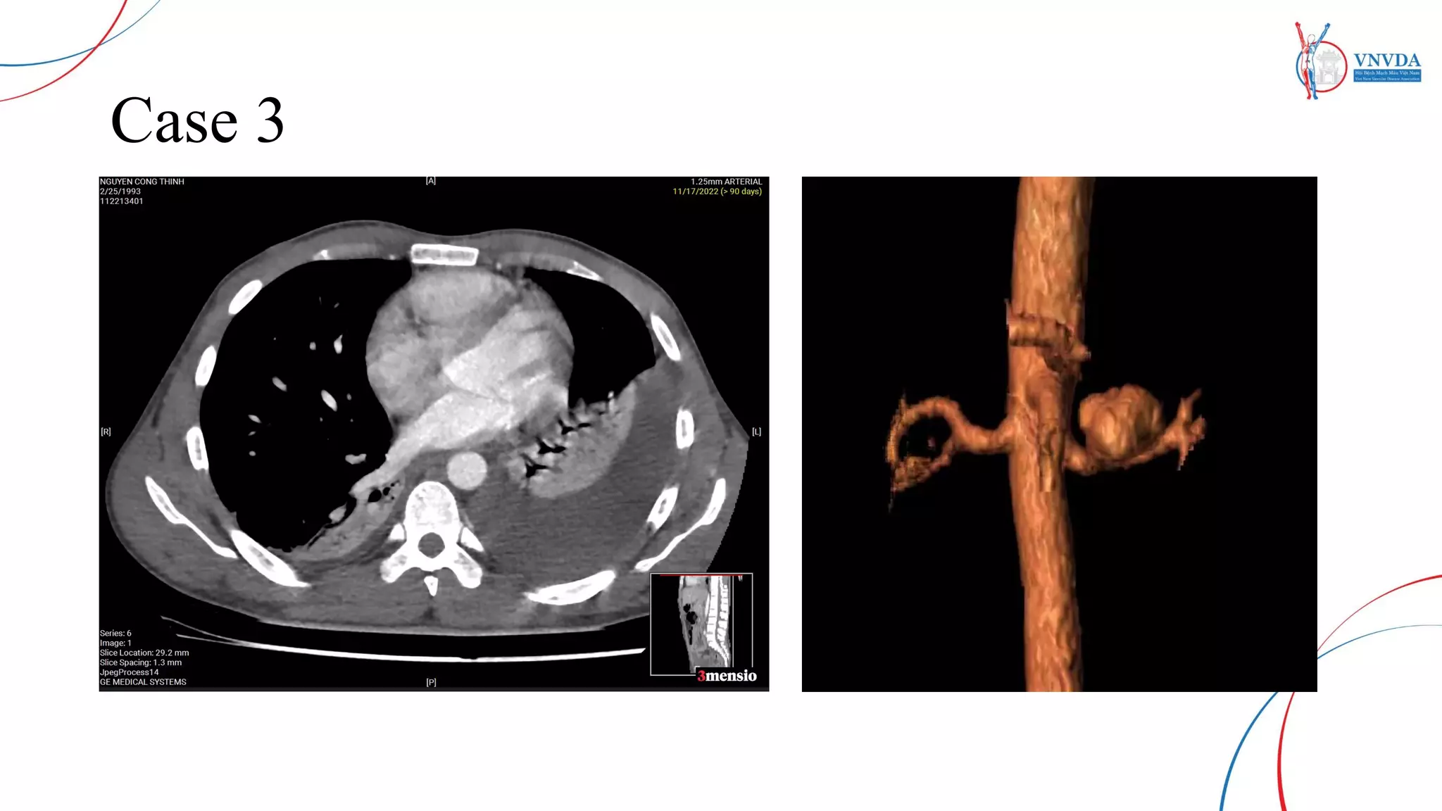 Intervention for Arterial Pseudoaneurysm | PDF