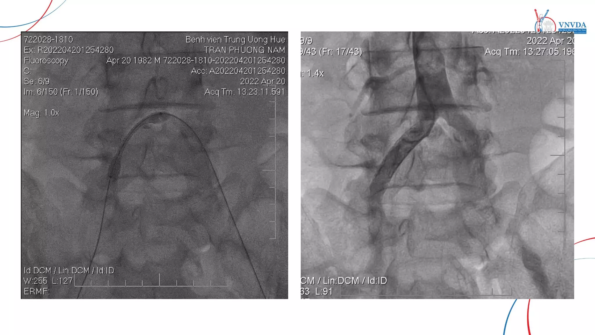 Intervention for Arterial Pseudoaneurysm | PDF