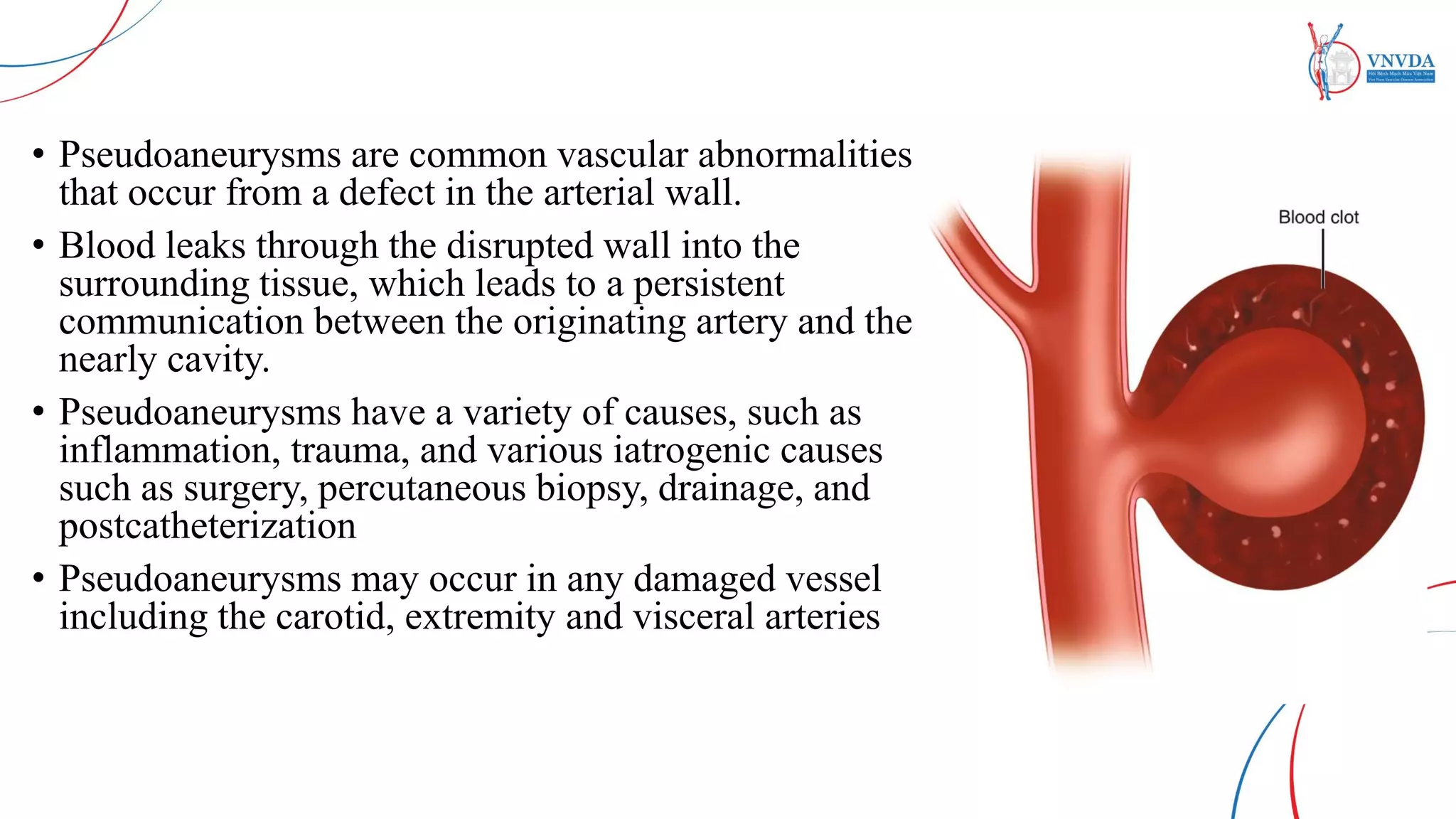 Intervention for Arterial Pseudoaneurysm | PDF
