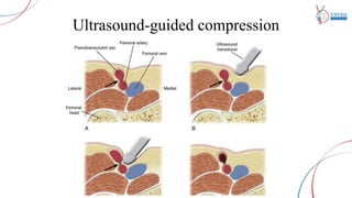 Intervention for Arterial Pseudoaneurysm | PDF | Blood Disorders ...