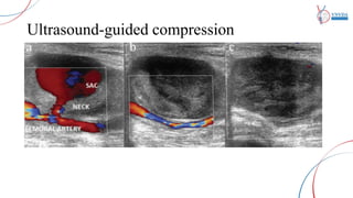 Intervention for Arterial Pseudoaneurysm | PDF | Blood Disorders ...