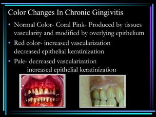 2.clinical features of gingivitis.ppt