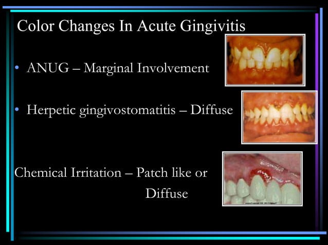 2.clinical features of gingivitis.ppt