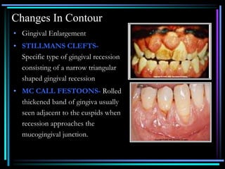 2.clinical features of gingivitis.ppt