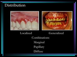 2.clinical features of gingivitis.ppt