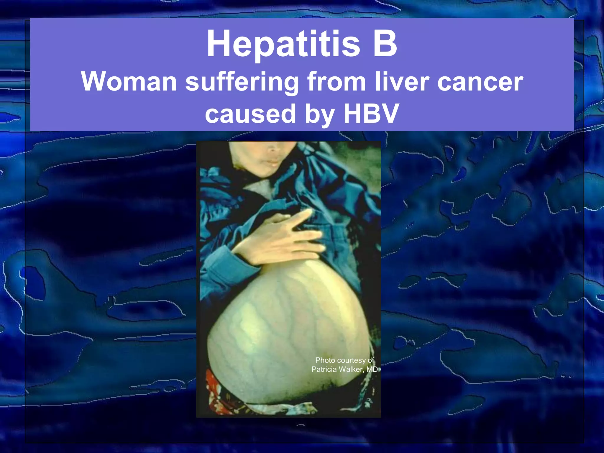SEXUAL TRANSMITED DISEASE (STD).ppt